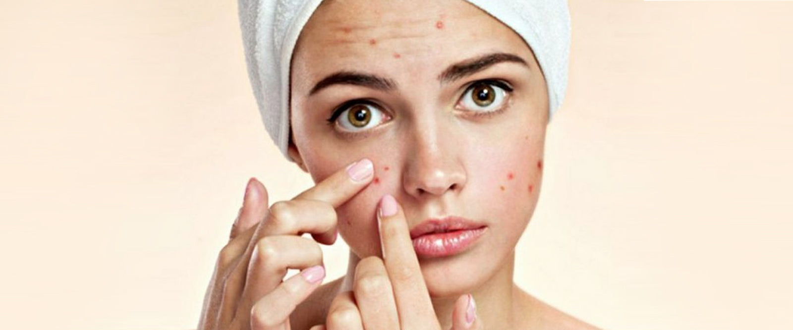 How to Remove Pimple Scars & Marks Naturally at Home?